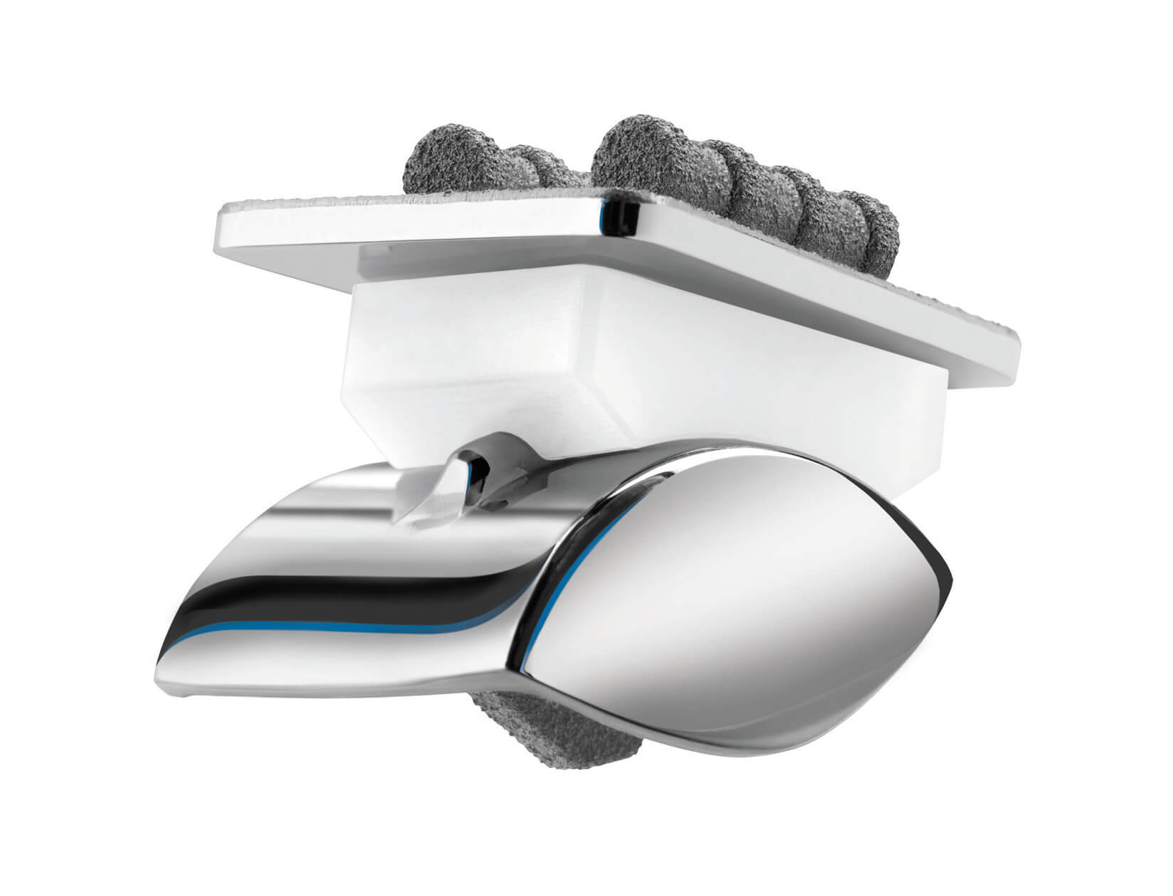 Salvage Of The Failed Total Ankle Replacement Foot Doctor San Diego La Jolla Podiatrist