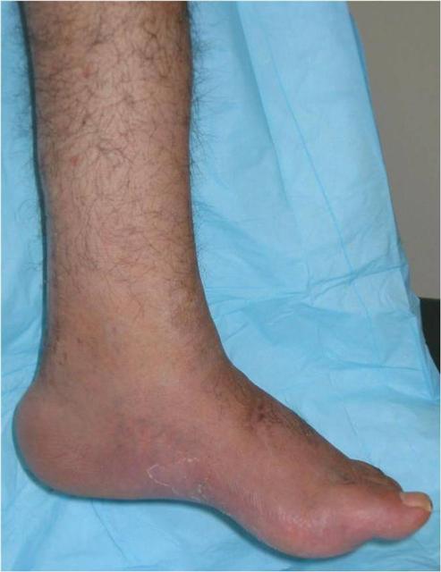 Cavus Foot and High Arches