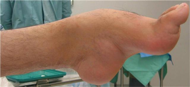 Cavus Foot and High Arches
