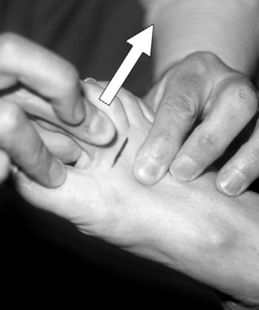 Plantar plate tears part 2 - Foot Doctor San Diego / La Jolla Podiatrist