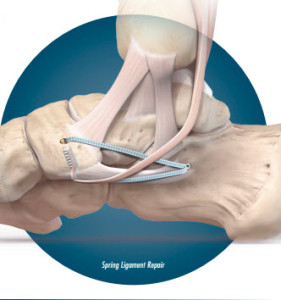FDL transfer with spring ligament - Foot Doctor San Diego / La Jolla ...