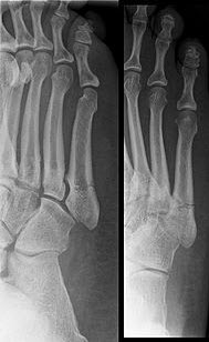 Kevin Durant Jones Fracture - Foot Doctor San Diego / La Jolla Podiatrist