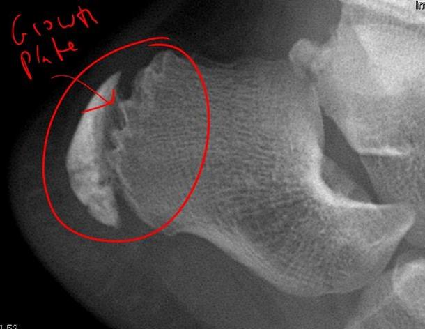 Heel Pain in Children - Foot Doctor San Diego / La Jolla Podiatrist