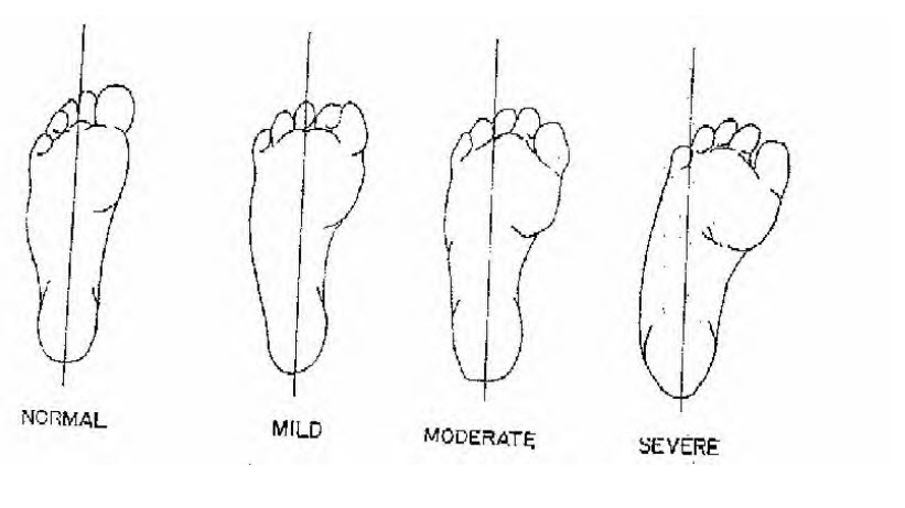 In-toe walking - Foot Doctor San Diego / La Jolla Podiatrist