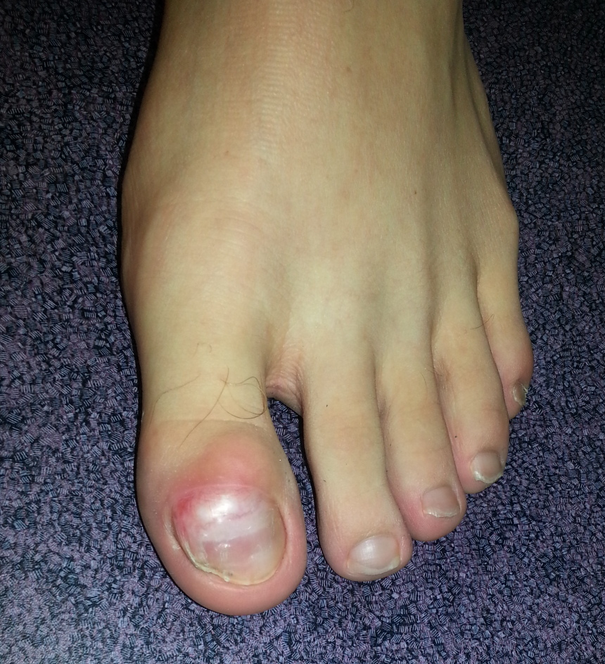 Ingrown Toenails - Foot And Ankle Doctor San Diego / La Jolla Podiatrist