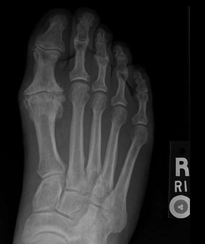 Severe Hallux Rigidus 1 - Advanced Foot And Ankle Center Of San Diego