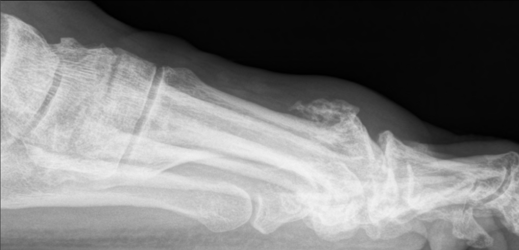 Hallux Rigidus lateral - Foot Doctor San Diego / La Jolla Podiatrist