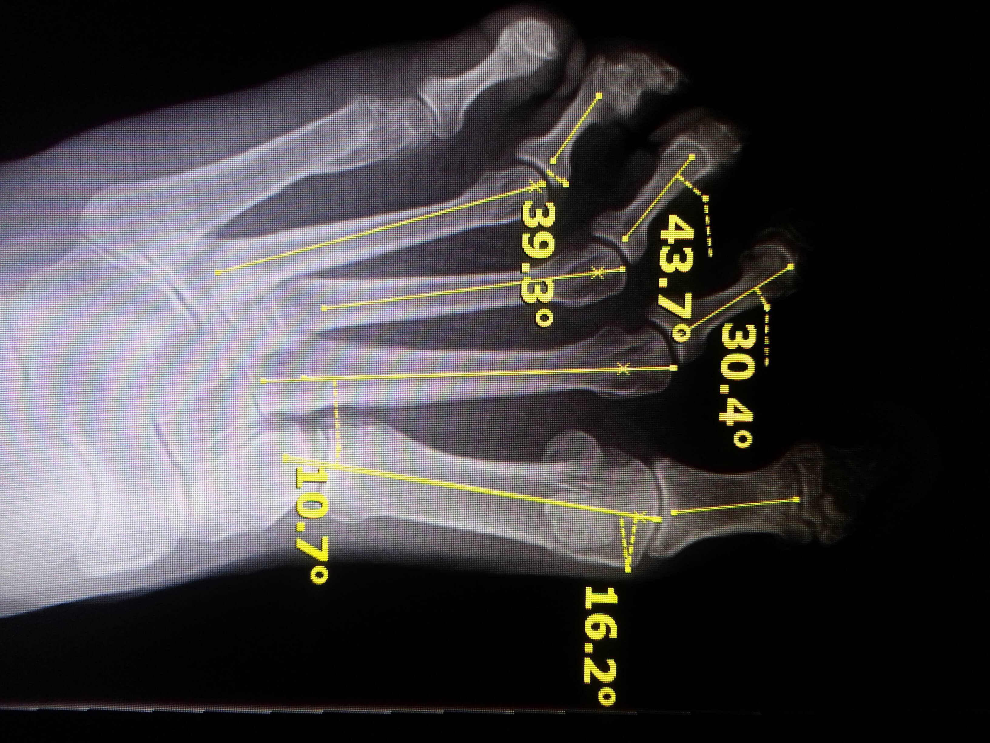 dislocated toes - Advanced Foot And Ankle Center Of San Diego