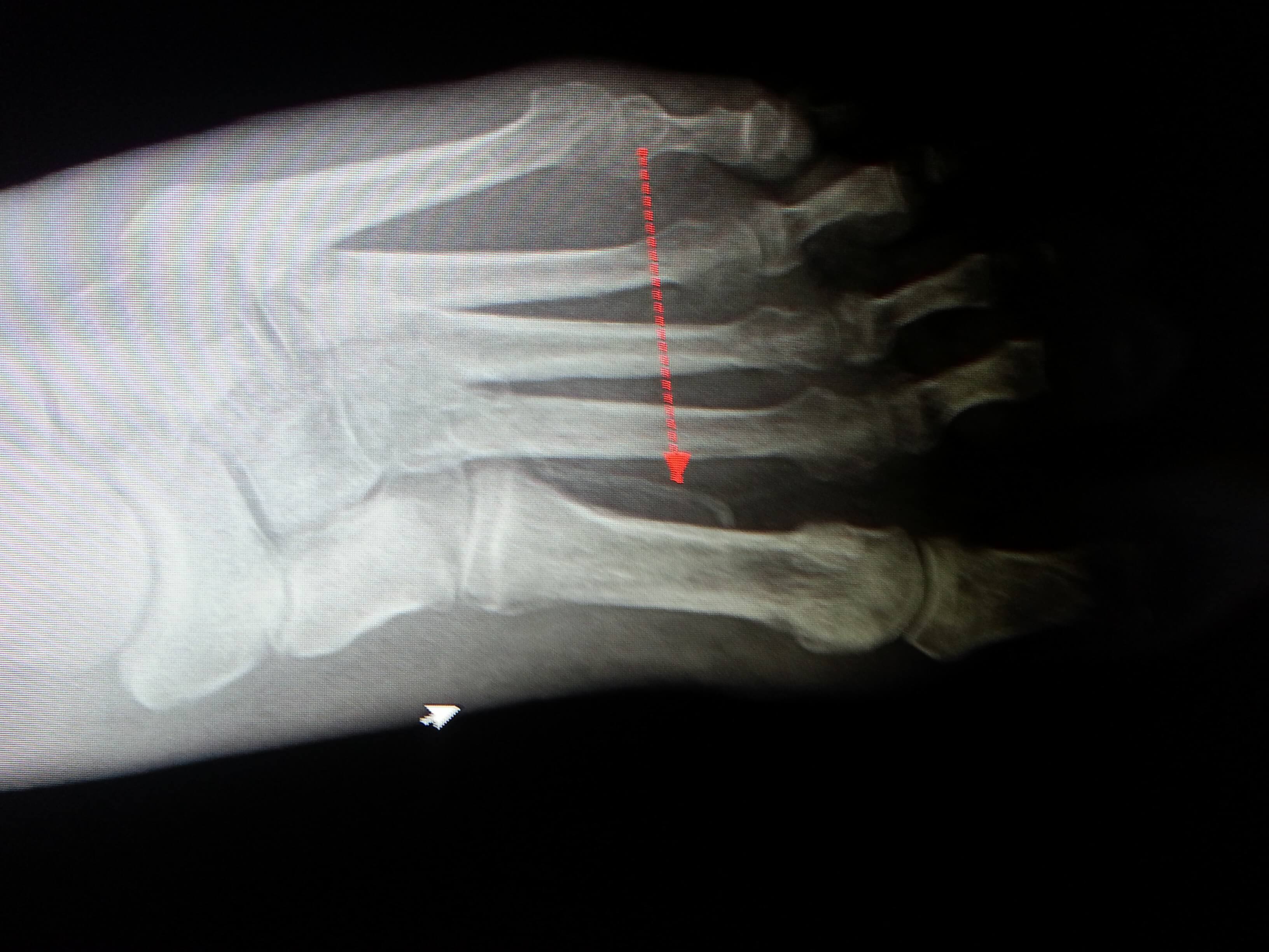 calcified foot arteries - Advanced Foot And Ankle Center Of San Diego