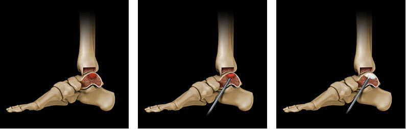 Ankle Subchondroplasty - Foot Doctor San Diego / La Jolla Podiatrist
