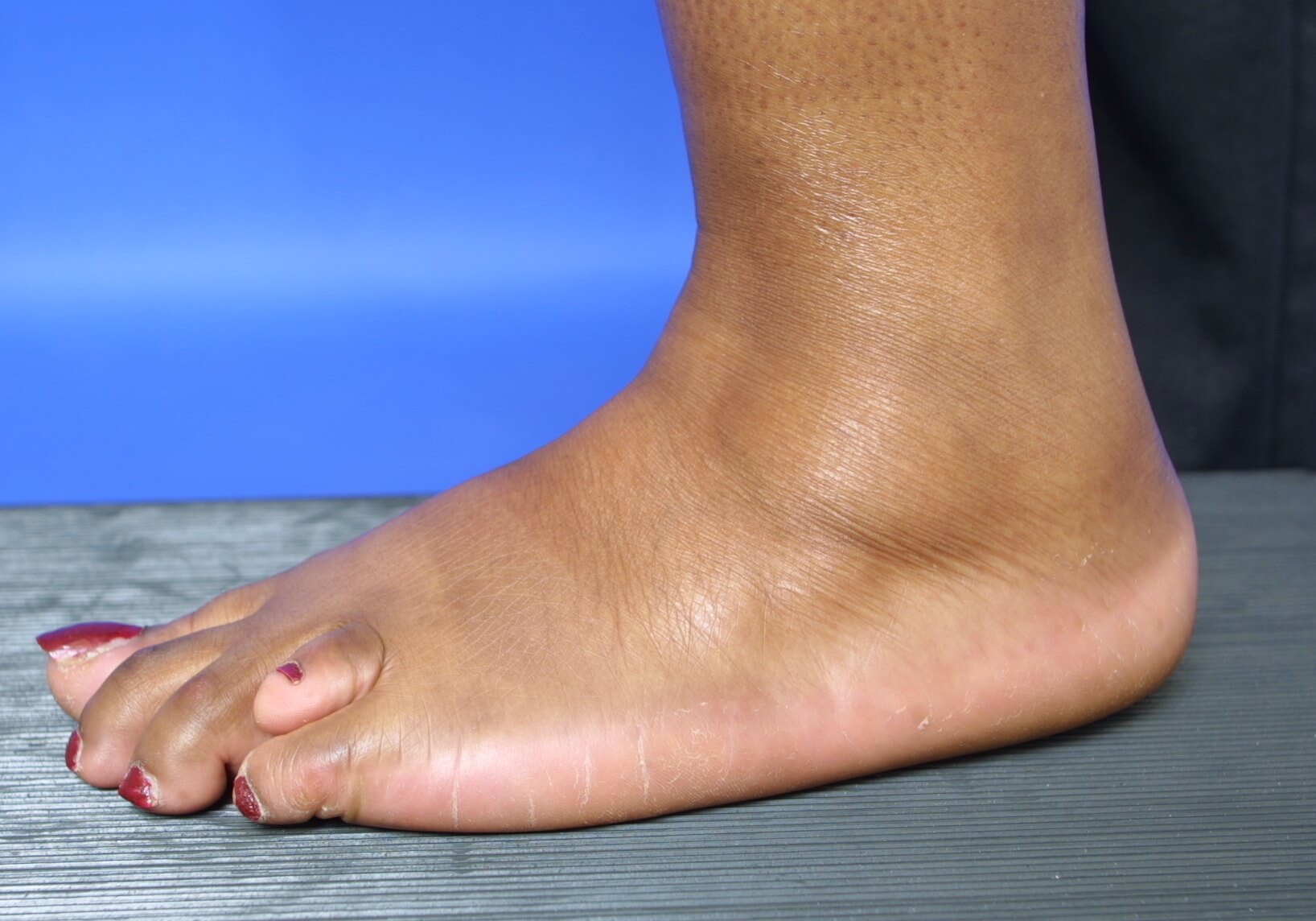 brachymetatarsia pre op - Advanced Foot And Ankle Center Of San Diego