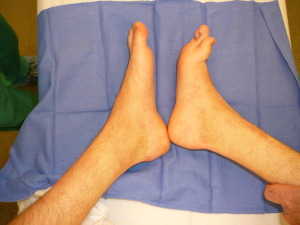 Brachymetatarsia - Foot Doctor San Diego / La Jolla Podiatrist