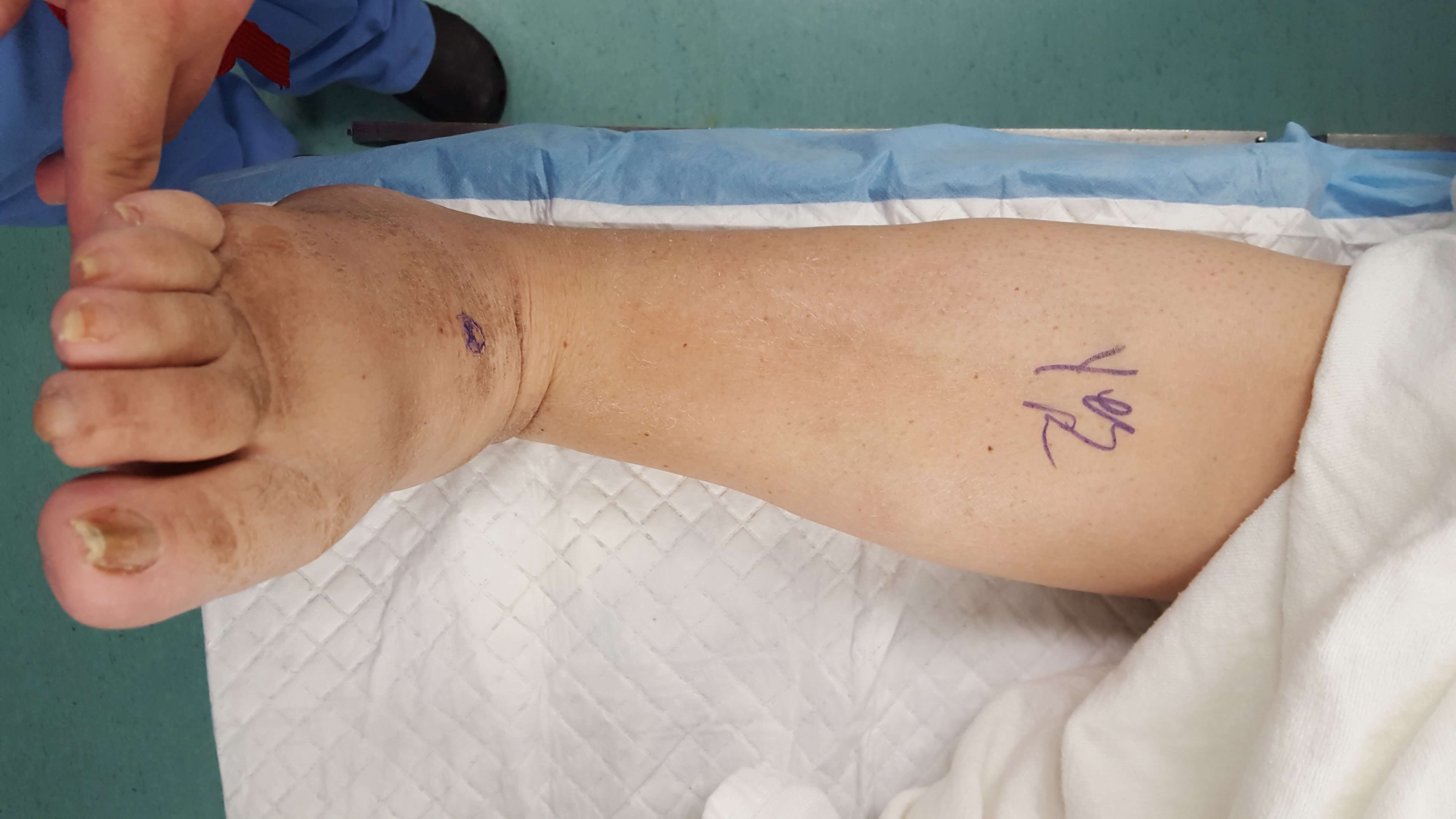 Charcot ankle surgery - Advanced Foot And Ankle Center Of San Diego